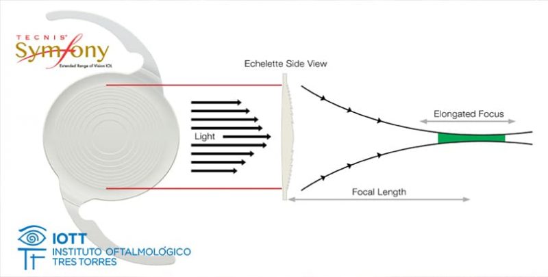 Conoce la lente intraocular de última generación Tecnis Symfony | IOTT ...