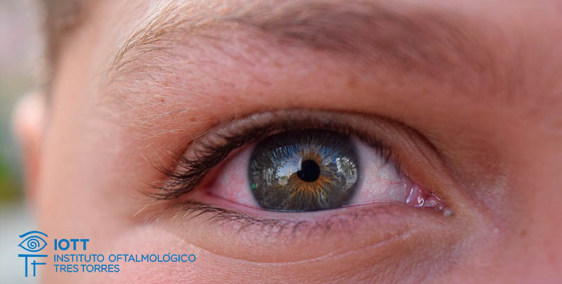 Conjuntivitis Identifica Sus Síntomas Tipos Y Cómo 51 Off