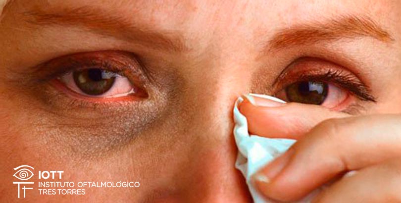 Consejos Para Evitar El Contagio De Conjuntivitis Instituto