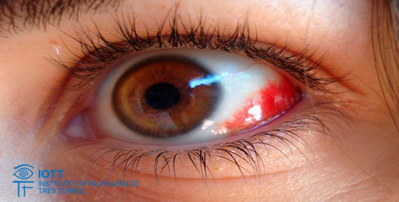 ¿Qué son los derrames oculares? | Instituto Oftalmológico Tres Torres